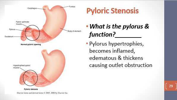 Peds GI - Pyloric stenosis, Hirschsprungs, Lactose Intolerance, Celiacs