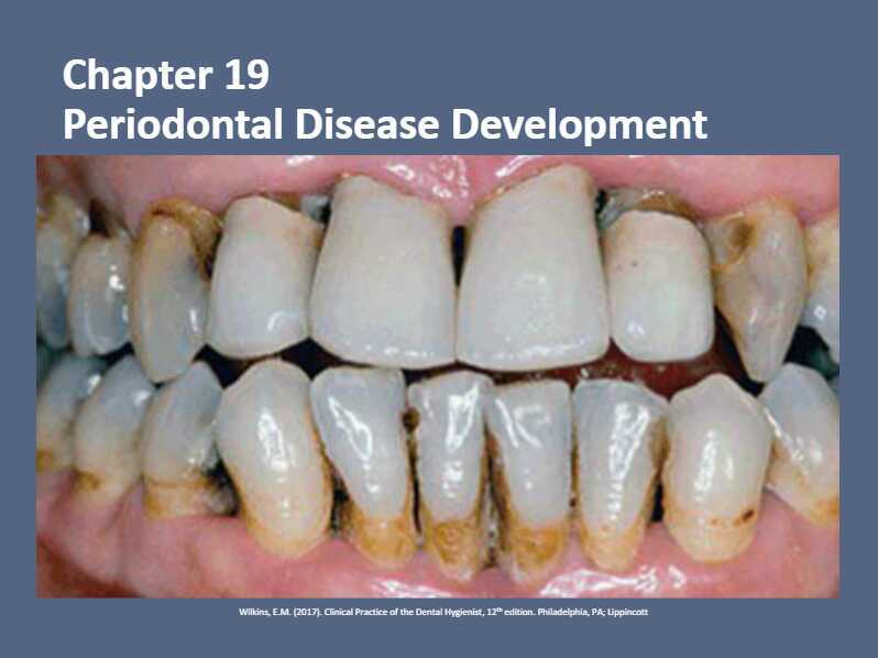Chapter 19 Perio Disease