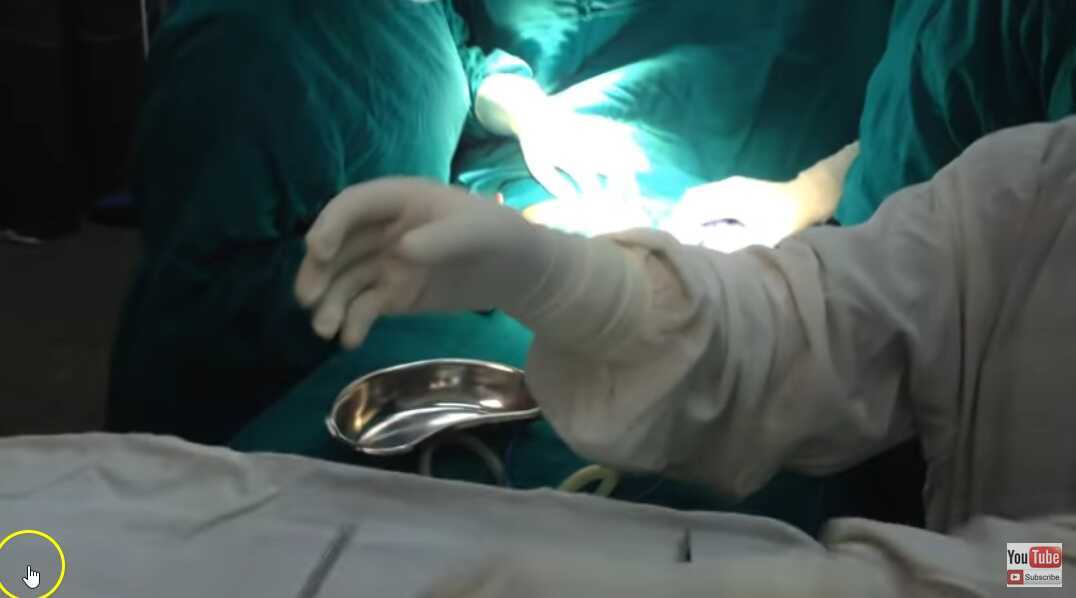 Cesarean Section Video