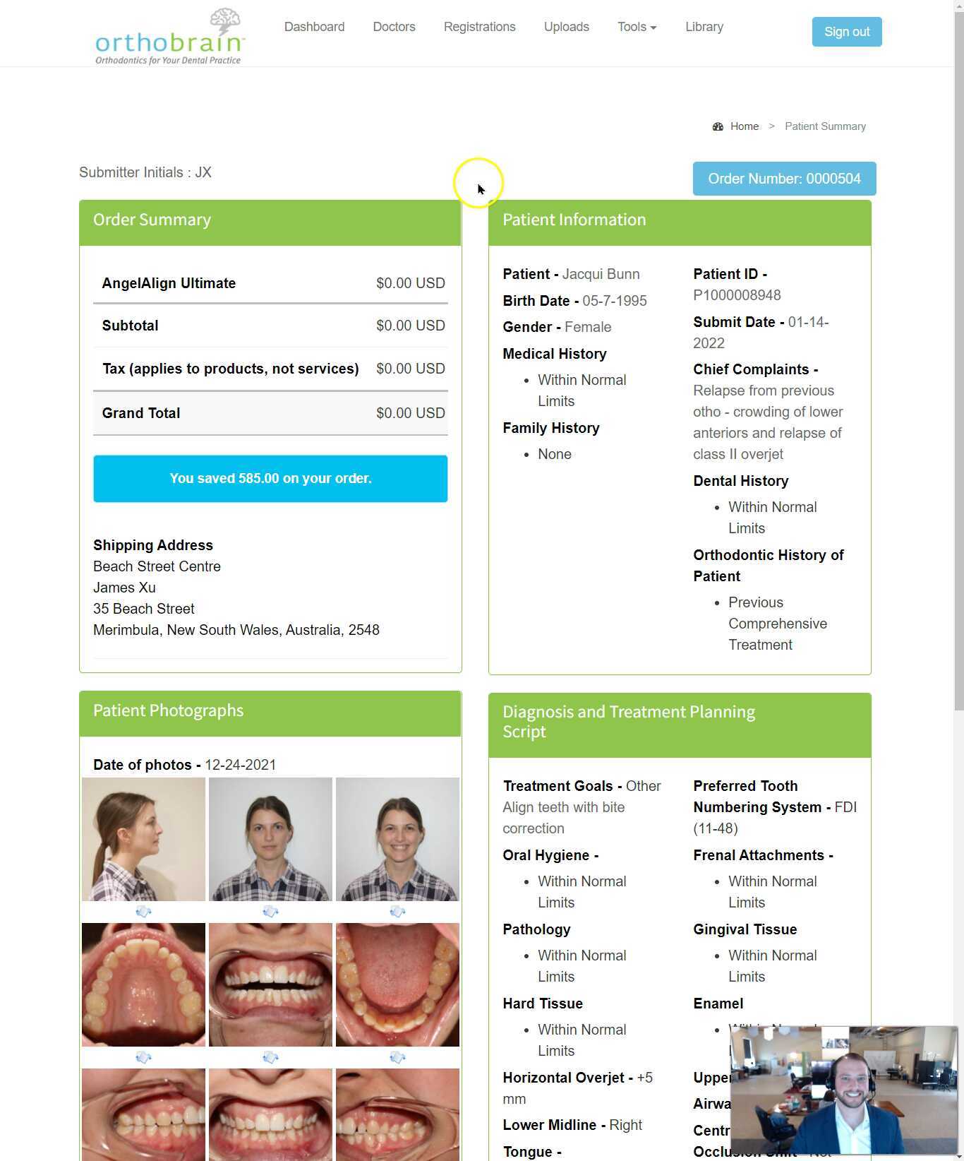 Angelalign 8948- Class II, midline discrepancy, moderate lower arch ...